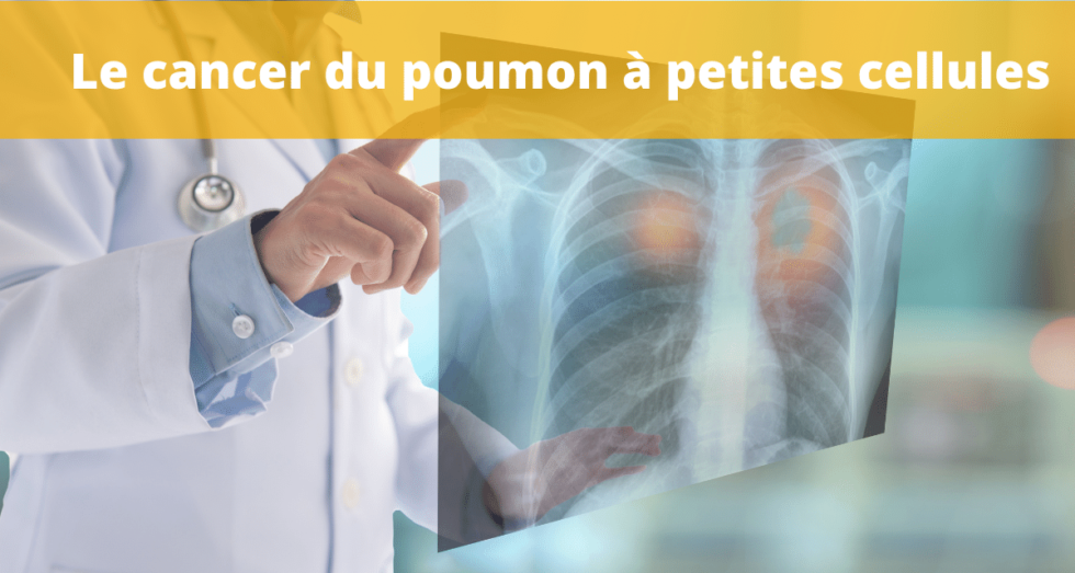 La radiothérapie dans le cancer du poumon à petites cellules
