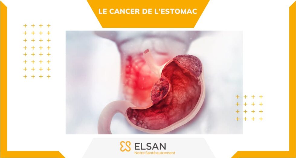Le Cancer Du Peritoine Est Il Mortel