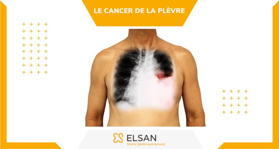Le cancer de la plèvre : Durée de vie et traitements